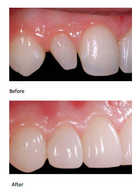 Peg Laterals and Bioclear |Blog - River Side Dental Practice